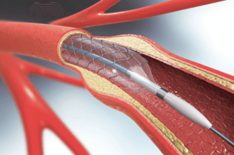 Endovascular Treatment in Los Angeles | ProVascular MD