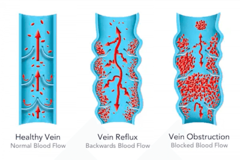 Venous Ulcer Treatment Los Angeles