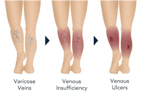 Venous Ulcer Treatment Los Angeles
