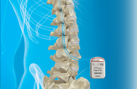 Spinal Cord Stimulator for Diabetic Neuropathy Los Angeles