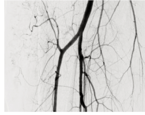 Peripheral Arterial Disease Screening Los Angeles